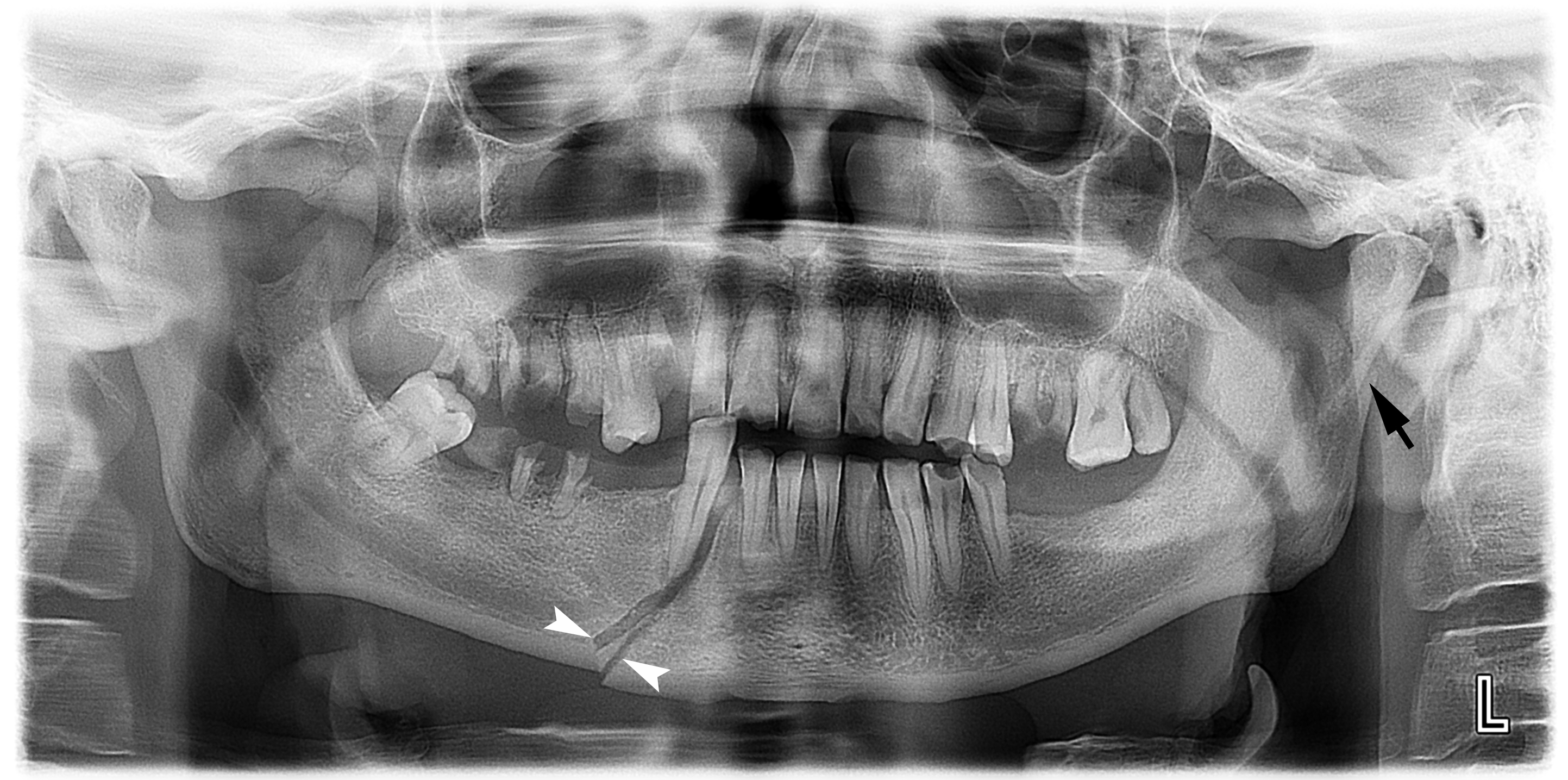 Mandibular Fracture X Ray Mandibular Fracture X Ray